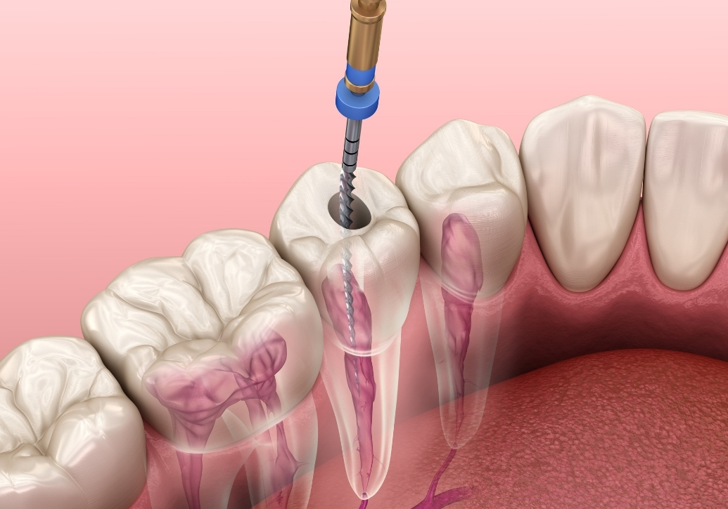 The Cost of Root Canal: 3 Critical Facts You Must Know